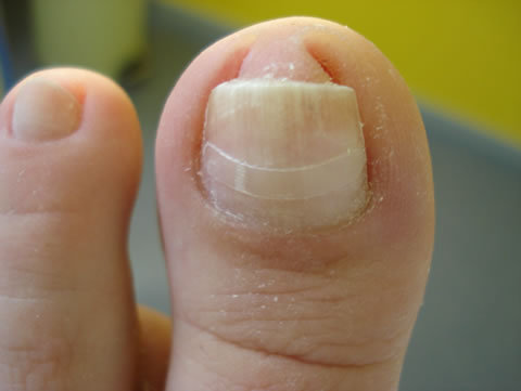 Nagelbeugeltechniek :: Praktijk Deknatel