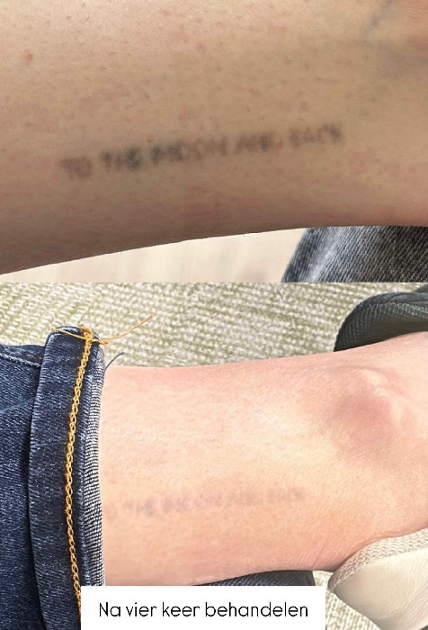 Tattoo verwijderen :: Praktijk Deknatel